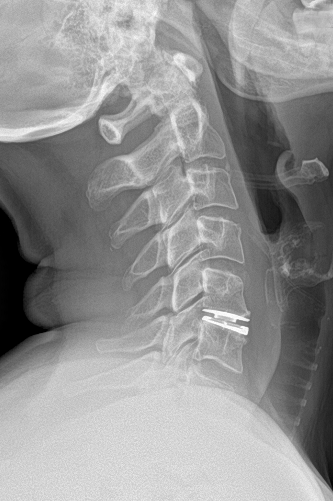 MOVE®-C - NGMedical